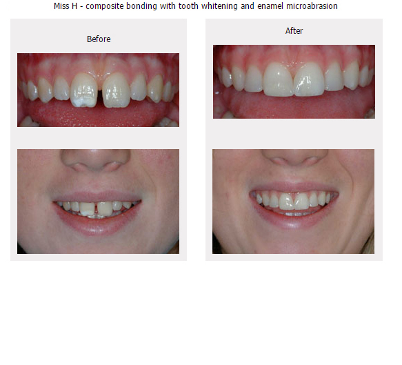 Composite Bonding Gallery Ilkley Dentist Leeds Yorkshire Bradford